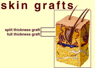 Skin Beauty - Skin Grafting Technique